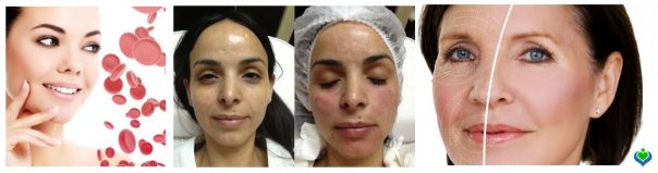 Vampire Lift Tunisie : therapie simulation collagene et injection prp